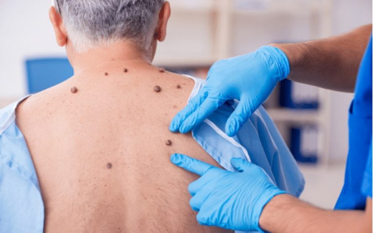 What to Expect After Skin Cancer Removal Surgery - Mining Your Health